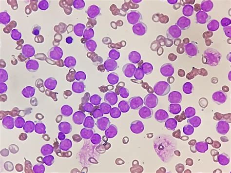 Premium Photo Lymphoblast On Microscopic Examination Acute