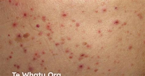 Septic Emboli Image