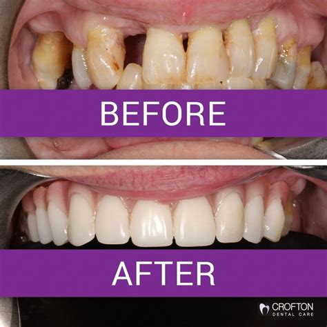 Cutting Dental Bridge At Edna Steele Blog