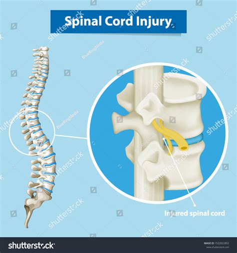 Diagram Showing Spinal Cord Injury Illustration Stock Vector Royalty Free