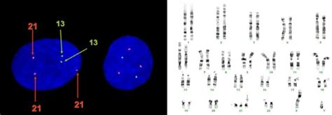 Diagnosis Of Sex Chromosome Disorders And Prenatal Diagnosis Of Down