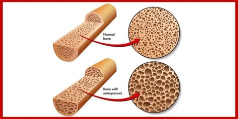 Diethylstilbestrol And Decreased Bone Mineralization Osteoporosis Diethylstilbestrol Des