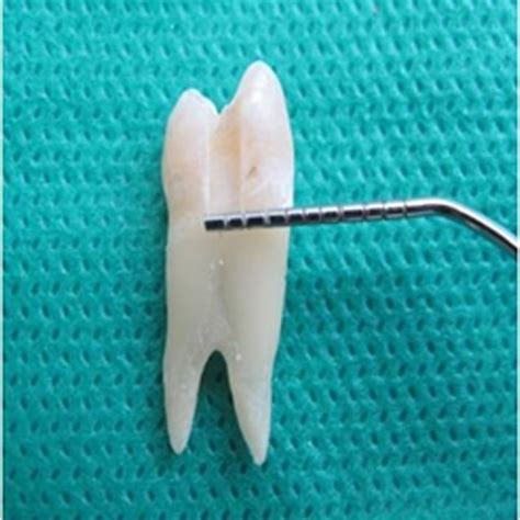Pdf Evaluation Of Microleakage Of Class Ii Dental Composite Resin Restorations Cured With Led