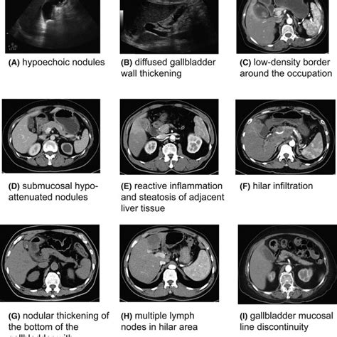 Xanthogranulomatous Cholecystitis Xgc And Gallbladder Carcinoma
