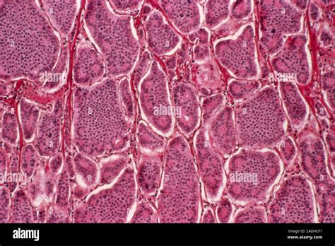 Intestinal Cancer Light Micrograph Of A Section Through A Carcinoid Tumour Of The Small
