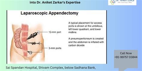 Exploring Laparoscopic Appendectomy
