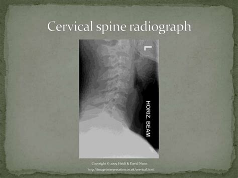 Wedge Compression Fracture Pptx