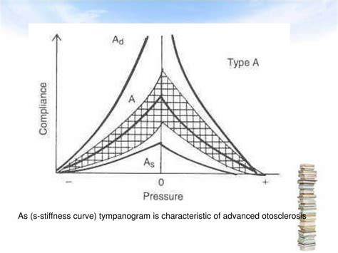 Ppt Otosclerosis Powerpoint Presentation Free Download Id 5505894