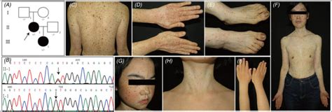 Two Novel Sash1 Mutations In Chinese Families With Dyschromatosis Universalis Hereditaria