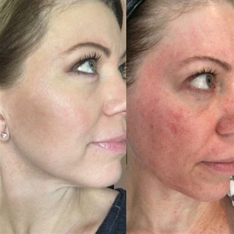 Microdermabrasion Vs Dermaplaning Vs Microneedling My Experience And