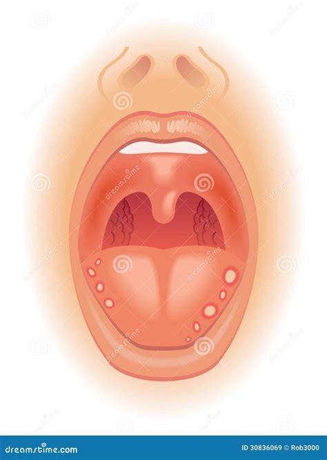 Tongue Sores Royalty Free Stock Images Image 30836069