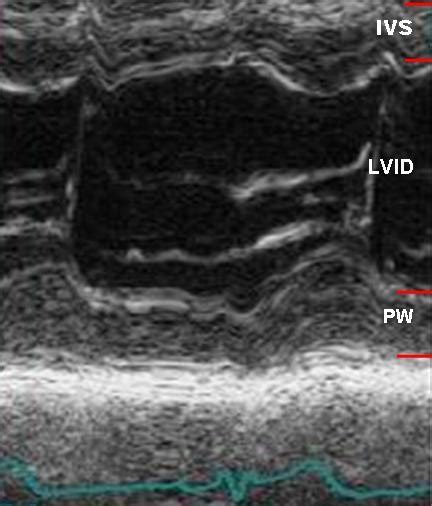 M Mode Left Ventricular Measurements Are Obtained In Parasternal Long Download Scientific