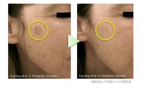 顔のシミ取りとレーザー治療 ‐ 老人性色素斑など4種のシミを解説！｜医療・健康コラム ファミリードクター