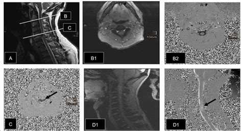 Patient With Spinal Cord Compression At Cervical Level C56 A Sagittal