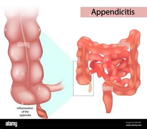 Appendicitis Operation Stock Vector Images Alamy