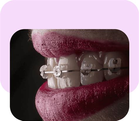 Orthodontic Brackets Dra Dubraska Mouawad