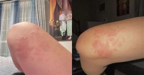 데일리 헬스 헬스장 기구 이용하다 40대 여성 결국 이 피부병 걸려