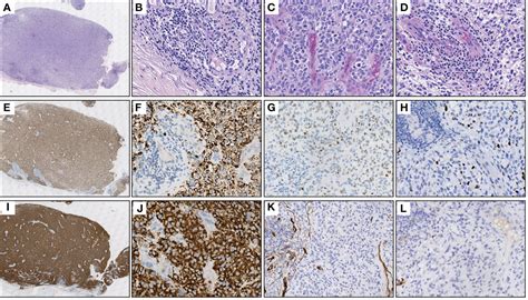 Frontiers Case Report An Ntrk1 Fusion Positive Embryonal