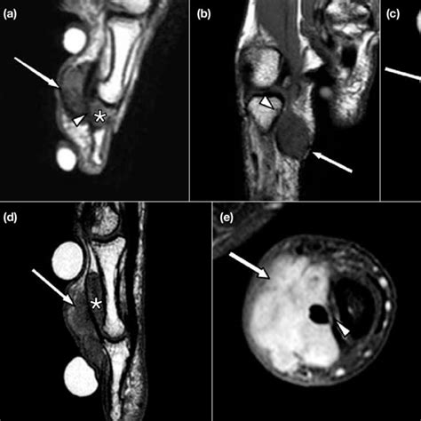 A A Sagittal Turbo Spin Echo Tse T1 Weighted Magnetic Resonance