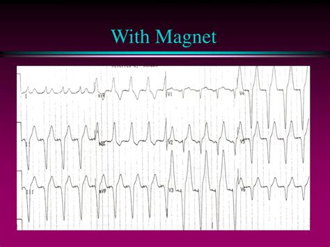 Ppt Pacemaker Malfunctions Powerpoint Presentation Free Download Id 4310263
