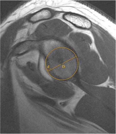 Measurement Of The Glenoid Diameter D And Bone Loss D Using The