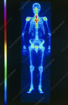 Skeleton Gamma Scan Stock Image P Science Photo Library