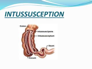 Clinical Features Of Intestinal Obstruction Pptx