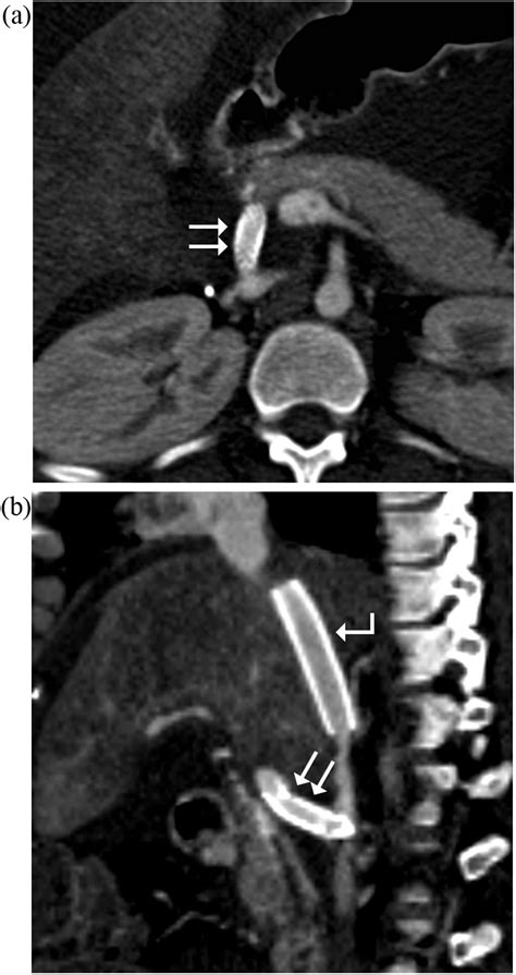 Assessment Of Surgical Portosystemic Shunts And Associated