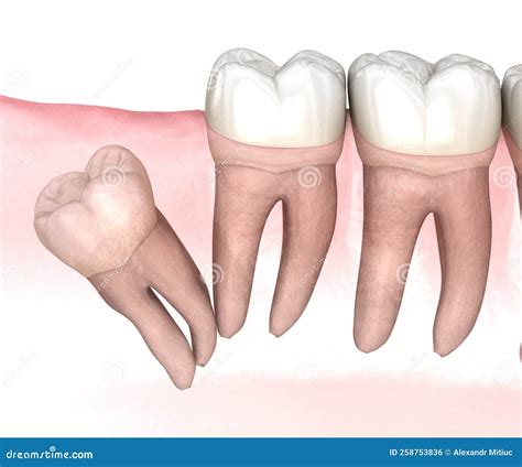 Distal Impaction Of Wisdom Tooth Medically Accurate Tooth 3d