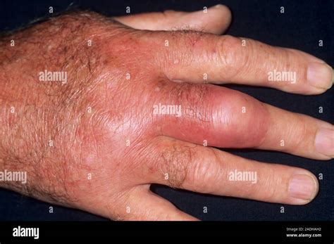 Cellulitis On A 74 Year Old Mans Hand Caused By Catching His Hand On A