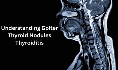 Understanding Goiter Thyroid Nodules And Thyroiditis Via Imaging