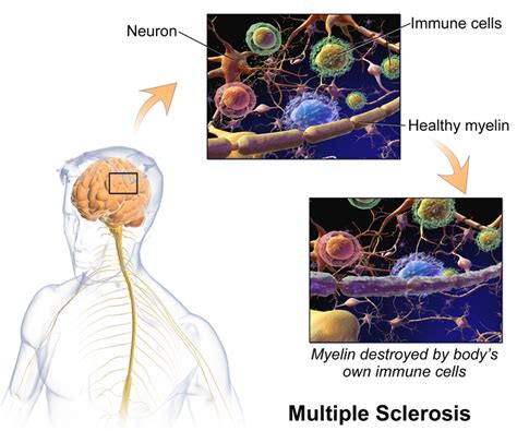 Difference Between Als And Ms Definition Pathophysiology Cause Signs And Symptoms Treatment