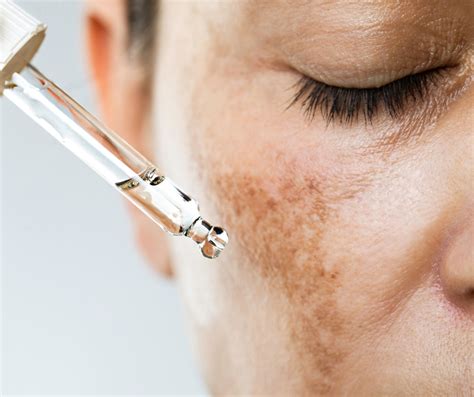 Hyperpigmentation Wellclinic