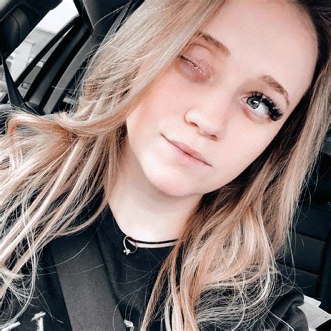 Pin On Eyepatch Blind Girl Pretty Face Wheelchair Women