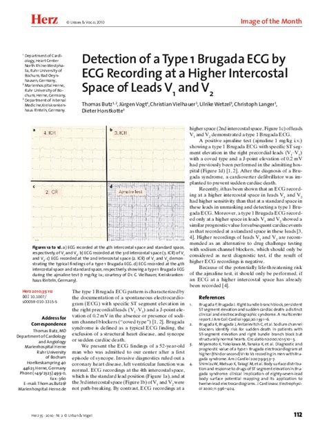 Pdf Detection Of A Type 1 Brugada Ecg By Ecg Recording At A Higher