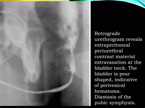 Imaging Of Urethral Injury Pptx