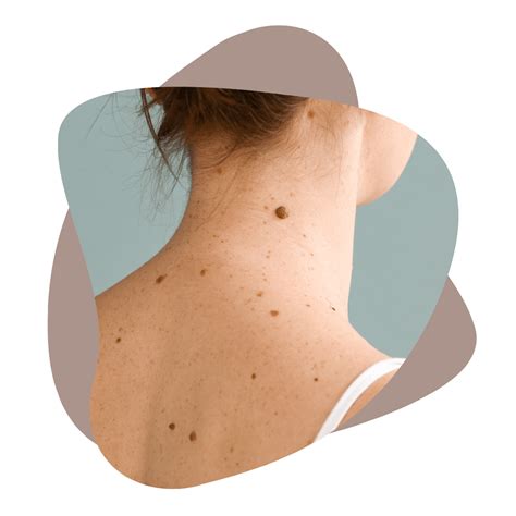 Moles Understanding Characteristics Concerns Diagnosis And