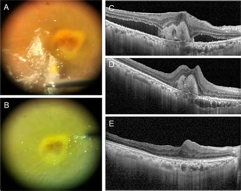 The Impact Of Removing The Epiretinal Membrane And Inner Limiting Membrane For Sustained
