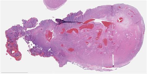 Histologia Do Angiofibroma Juvenile Angiofibroma Histology And