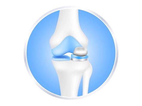 An Experts Guide To Partial Knee Replacement Surgery