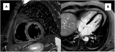Third Degree Atrioventricular Block Associated With The Sars Cov 2 Mrna Vaccine Revista
