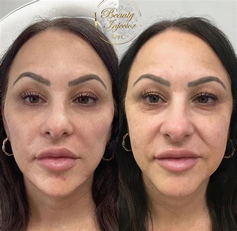 Before And After Discover Your Transformation Today — Beauty Injector Nyc