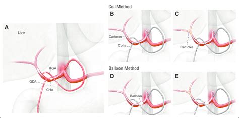 Comparison Of Coil Embolization And Balloon Occlusion Techniques For