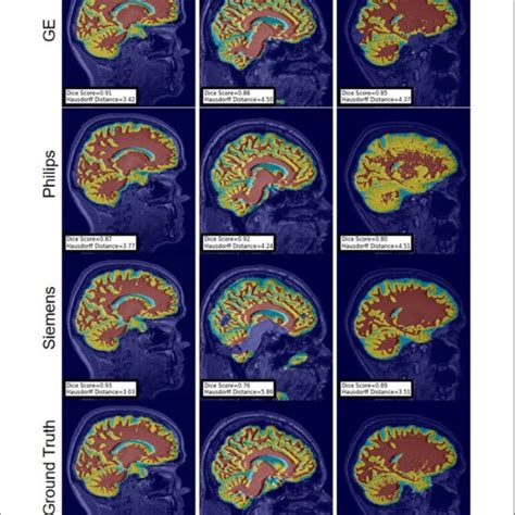 figure representative sample wm gm csf segmentation generated by the download scientific