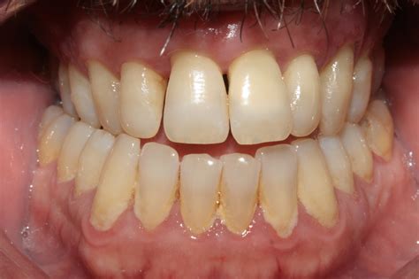 Case Gallery Clearcorrect