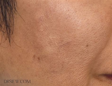 What You Need To Know About Pdo Thread Lift Non Surgical Skin Lifting