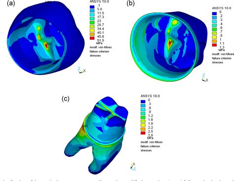 Figure 3 From Three Dimensional Finite Element Analysis Of Molars With Thin Walled Prosthetic