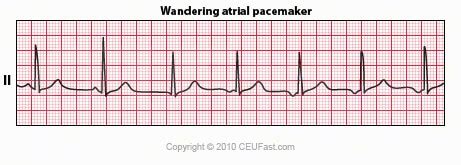 Wandering Atrial Pacemaker Rhythm Strip