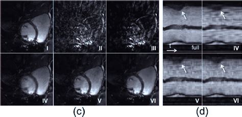 Figure 1 From Motion Compensated Compressed Sensing Dynamic Mri With
