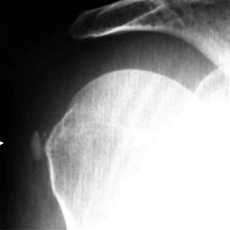 Pdf Calcific Tendinopathy Of The Rotator Cuff Conservative
